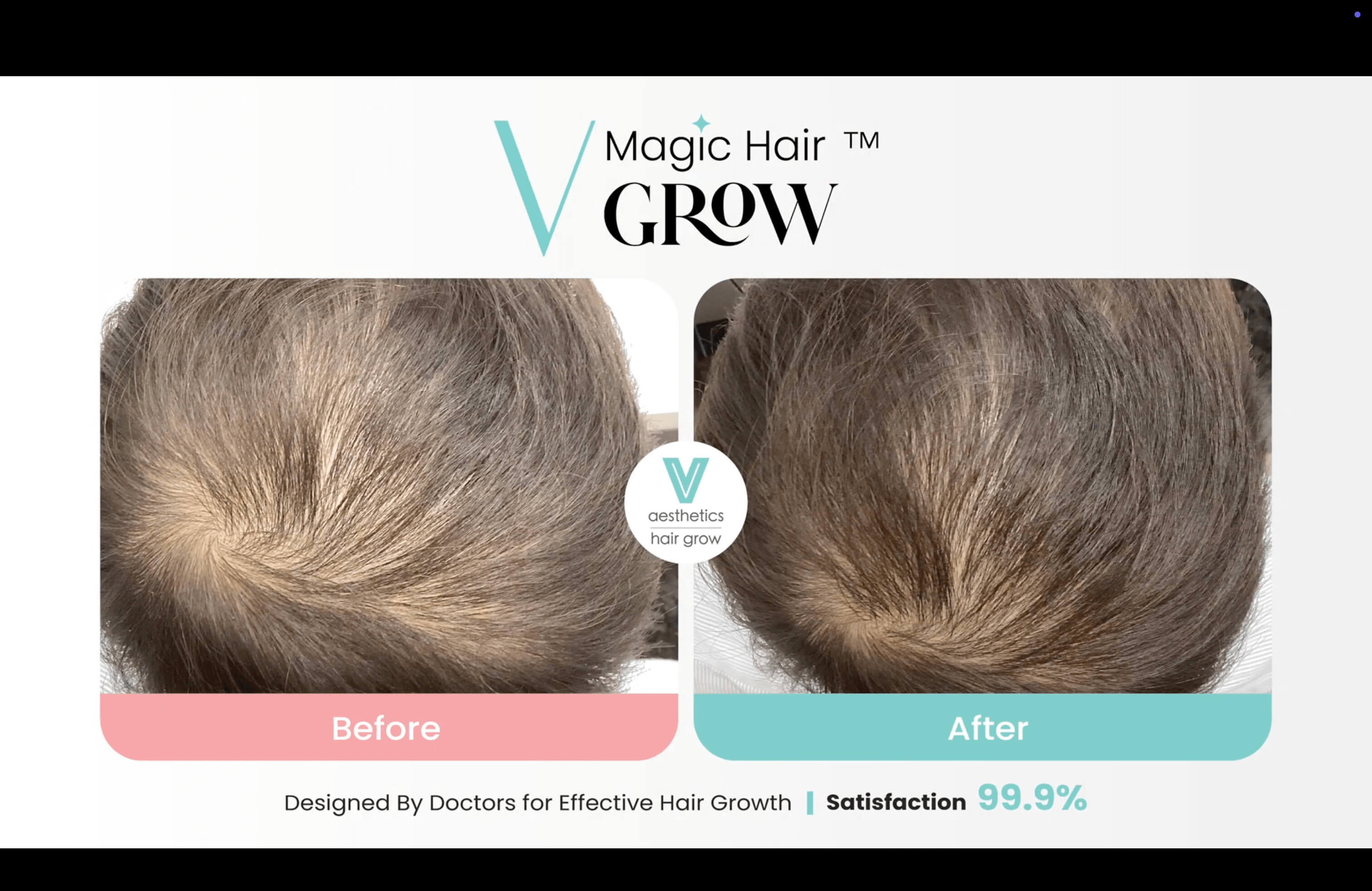 V Hair Treatment For Hair Loss Singapore | V Aesthetics Hair Grow