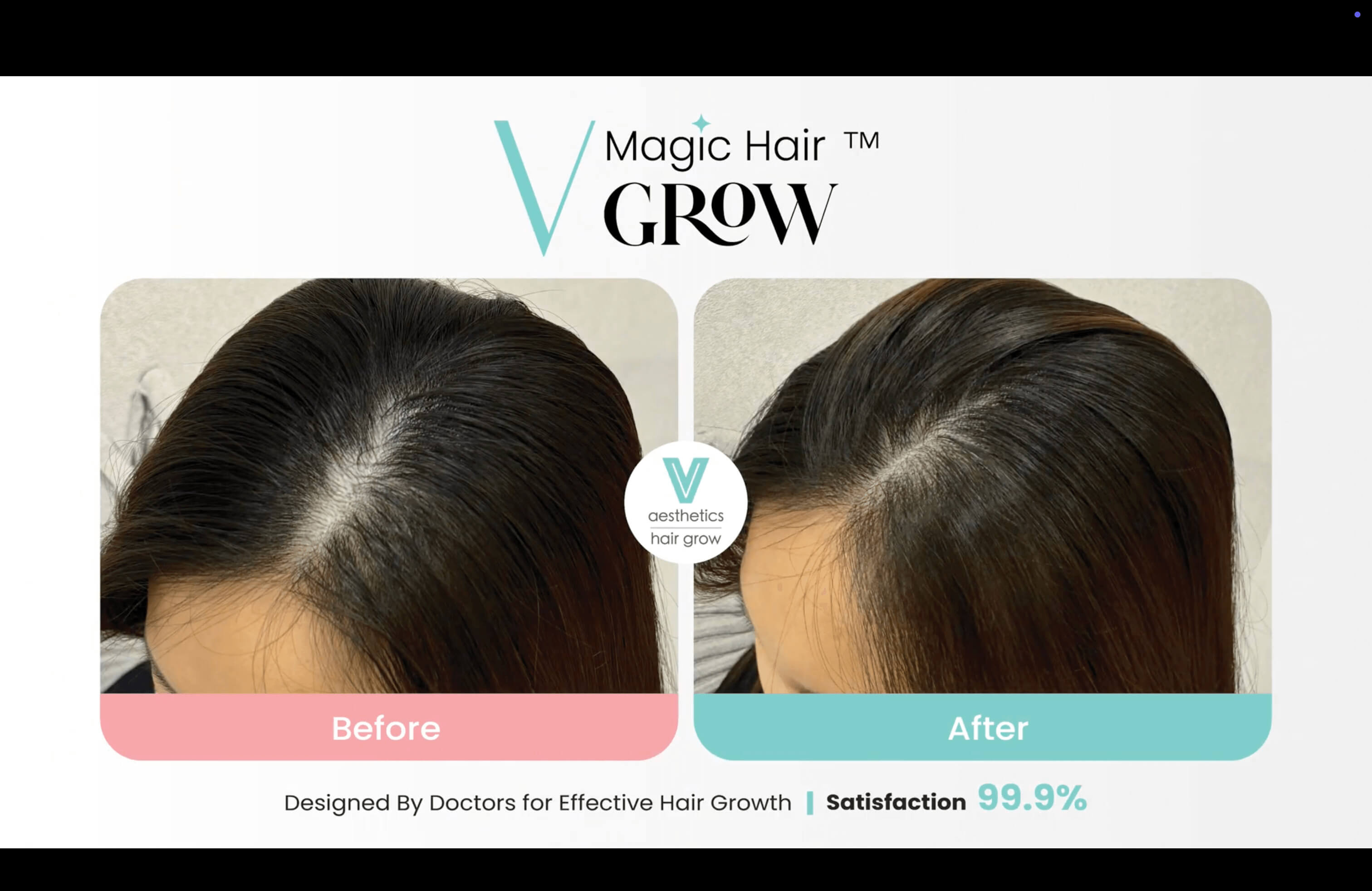 V Hair Treatment For Hair Loss Singapore | V Aesthetics Hair Grow